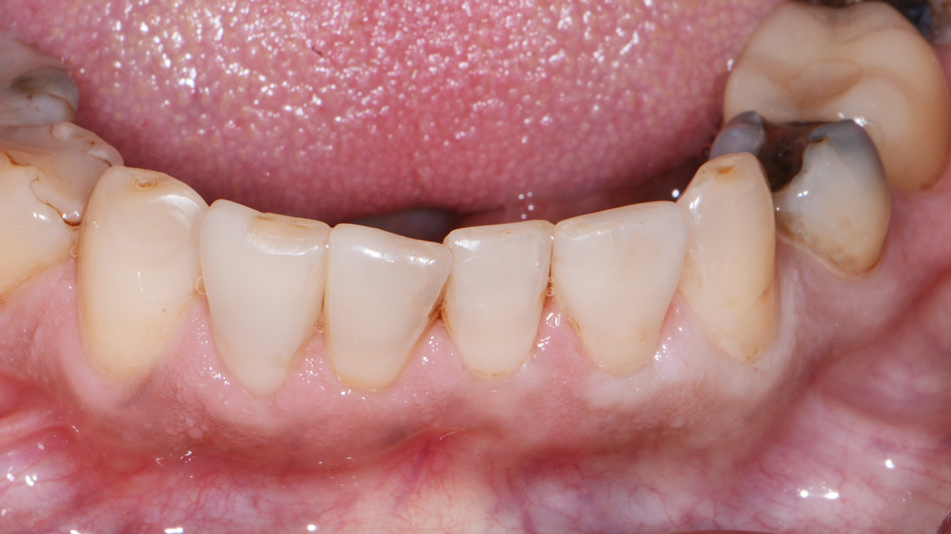 Case Study on Chipped Lower Teeth in Ballwin, MO | Dentistry