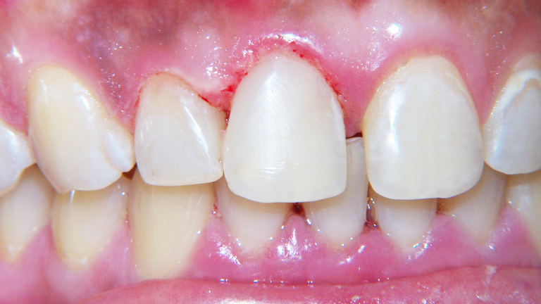 Case Study in Tooth Decay in Ballwin, MO | Dentistry