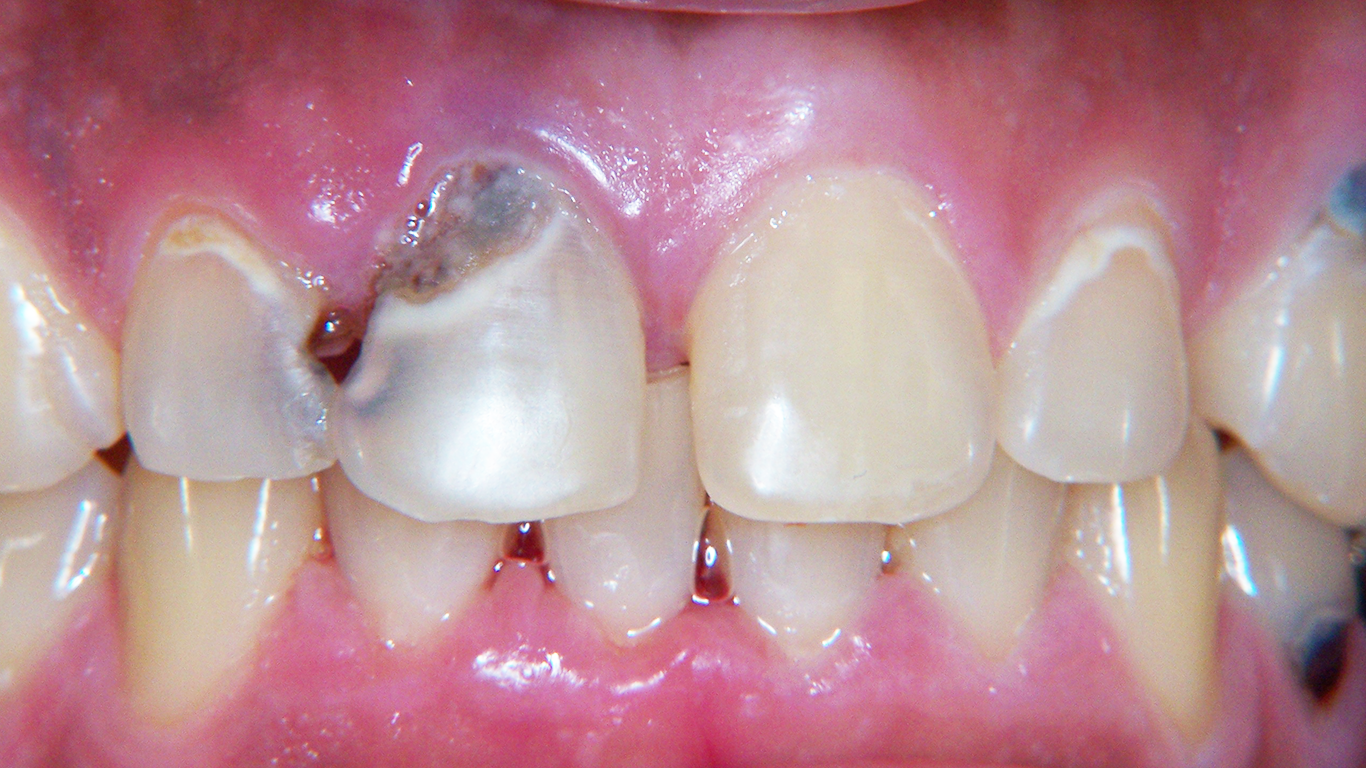 Case Study In Tooth Decay In Ballwin And Manchester MO Dentistry Case Study In Tooth Decay In Ballwin And Manchester MO Dentistry